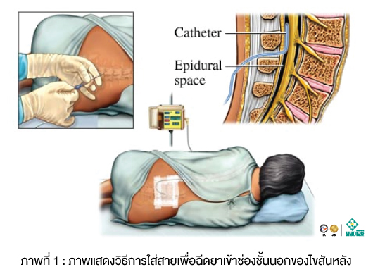 โรงพยาบาลนนทเวช - คำแนะนำการระงับความปวด ในระหว่างเจ็บครรภ์คลอด