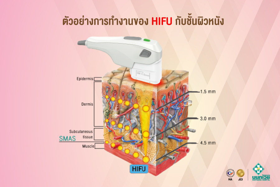 Hifu ยกกระชับหน้า – ปรับรูปหน้าเรียว l โรงพยาบาลนนทเวช